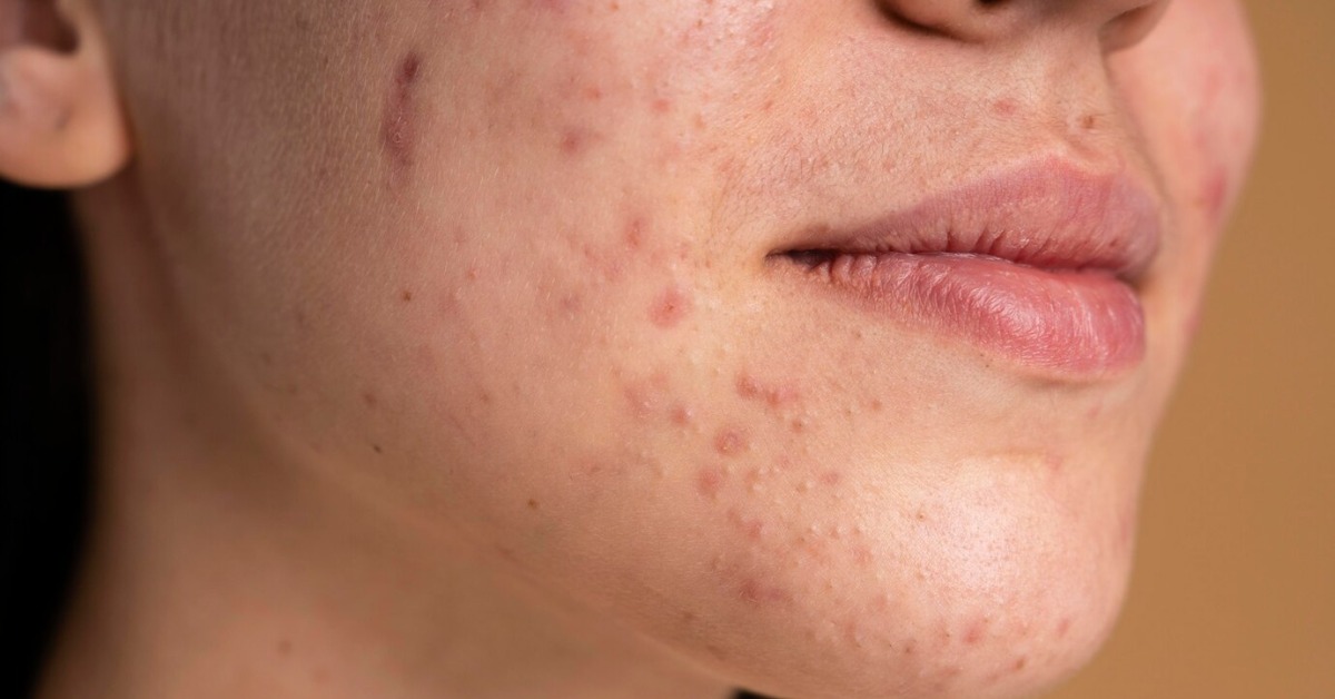 Omega 3 Deficiency Symptom, Causes, Diagnosis and Treatment
